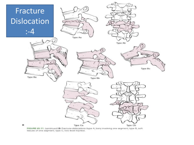 thoracolumbar injury classification severity score .pptx
