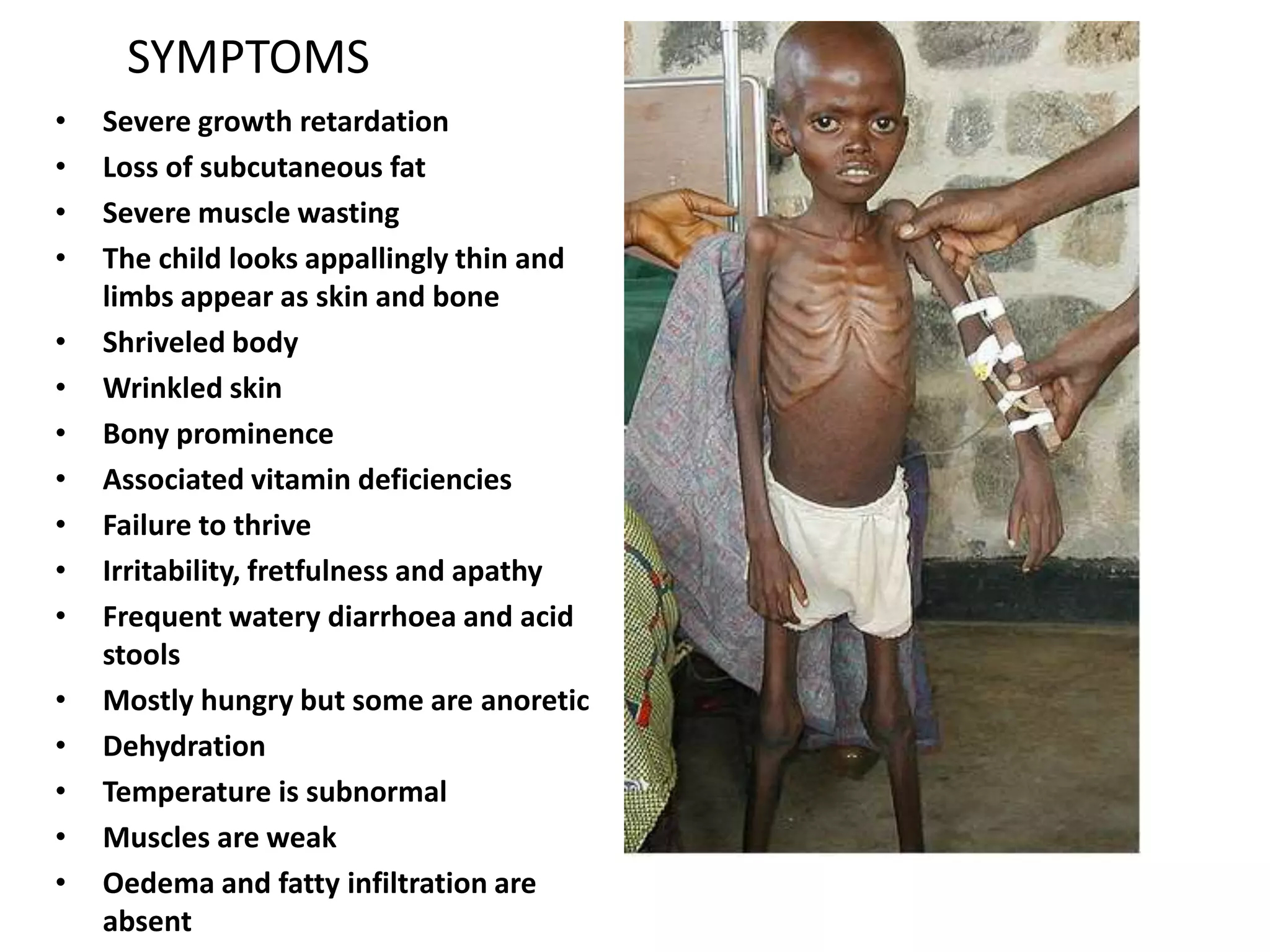 1.malnutrition | PPTX