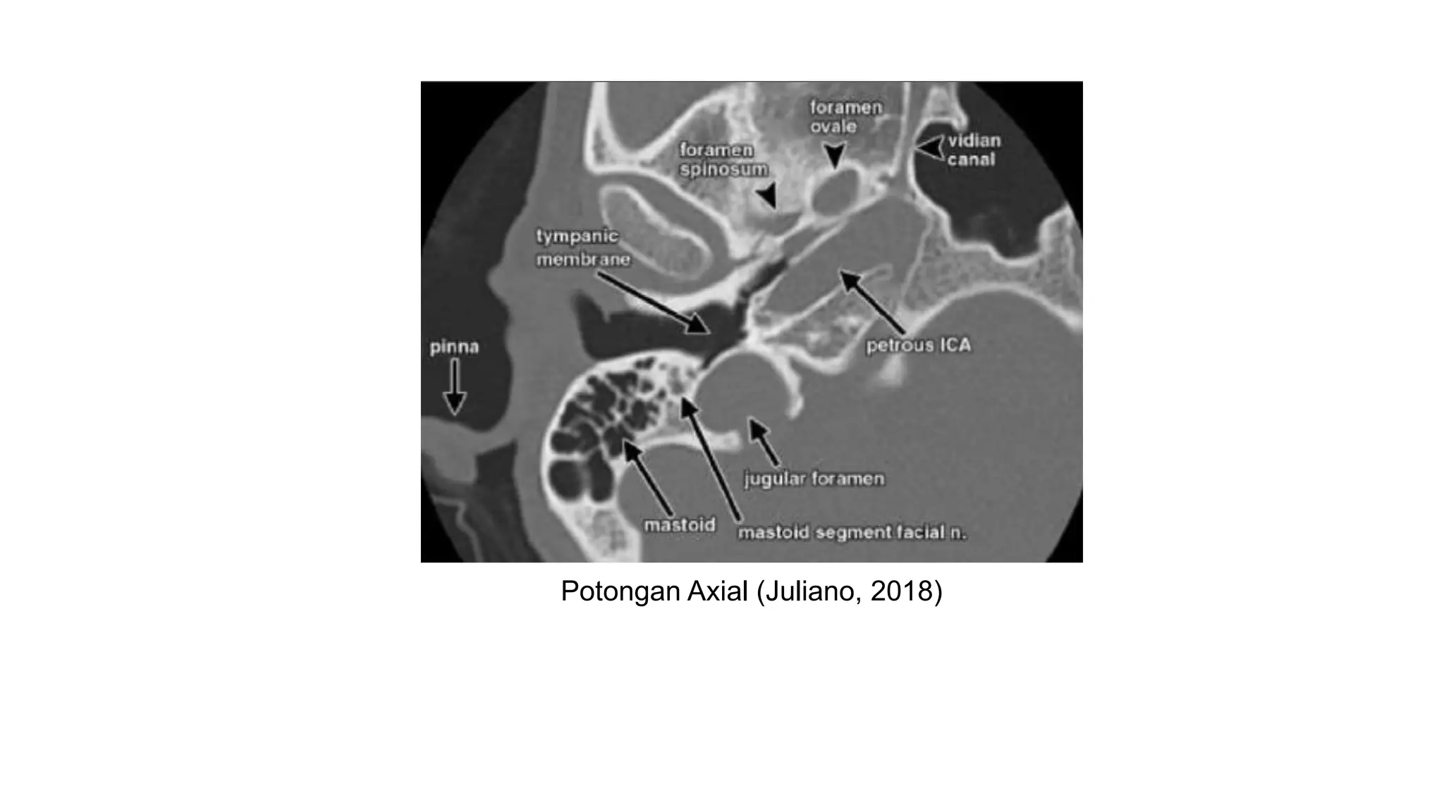 TM 11_CT SCAN MASTOID.pptx TEKNIK CT SCAN DASAR | PPTX