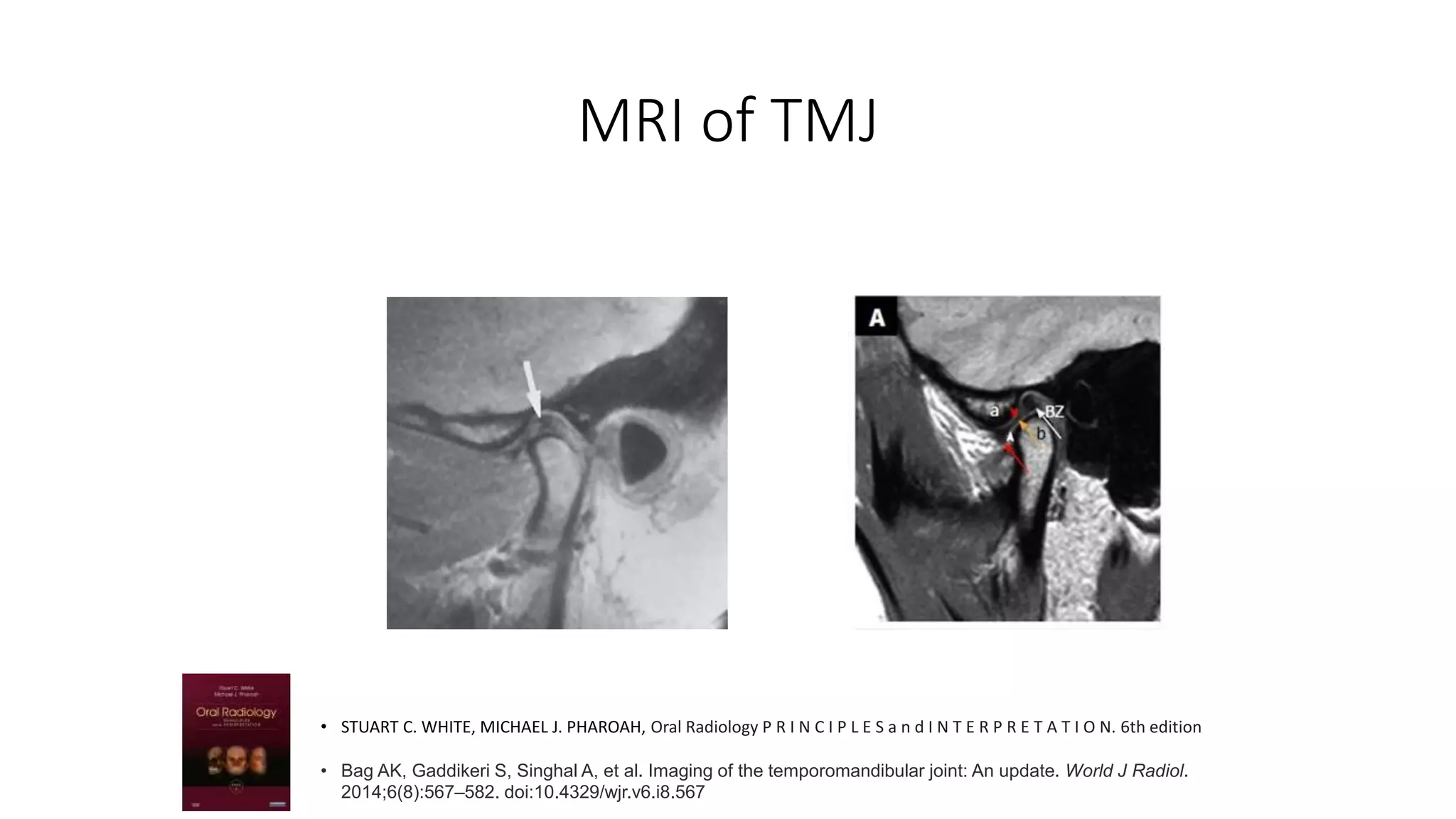 Temporomandibular Joint Disorders (TMD) | PPTX