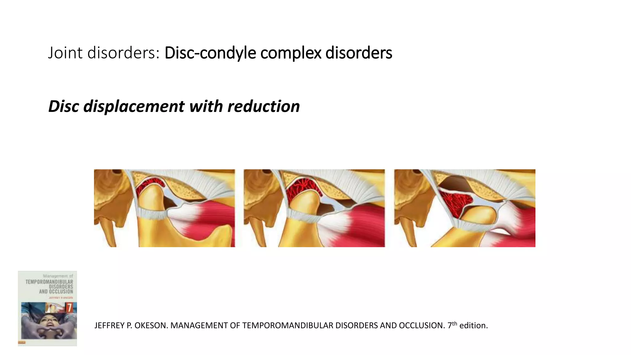 Temporomandibular Joint Disorders (TMD) | PPTX