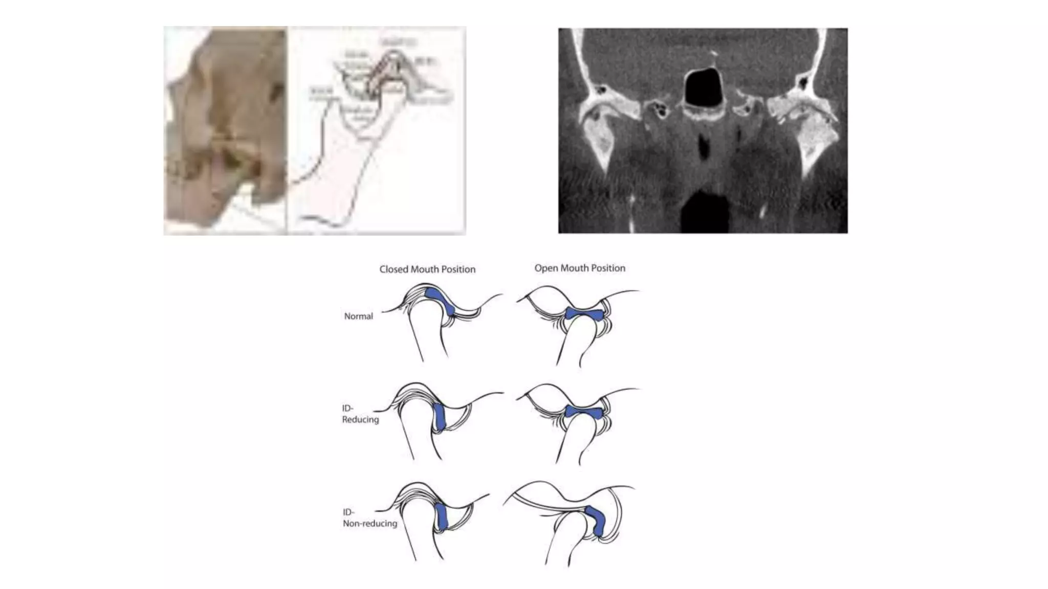Temporomandibular Joint Disorders (TMD) | PPTX