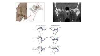 Temporomandibular Joint Disorders (TMD) | PPTX