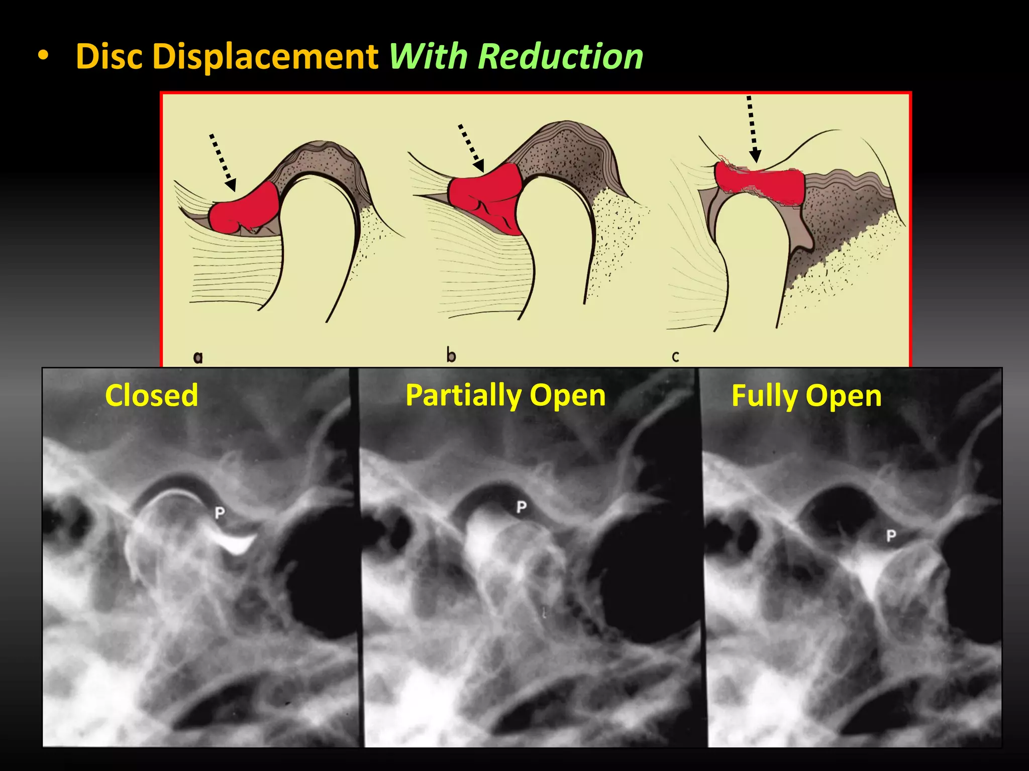 TMD's and occlusal splint therapy | PDF