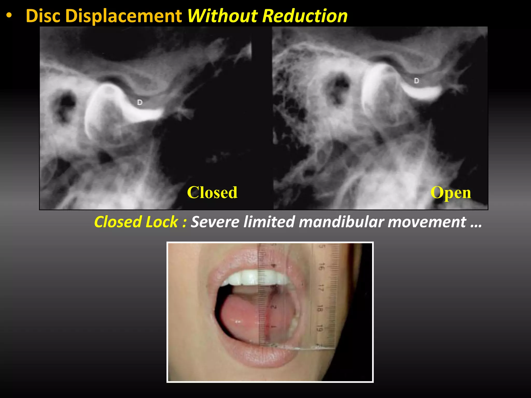 TMD's and occlusal splint therapy | PDF | Bone and Joint Conditions ...