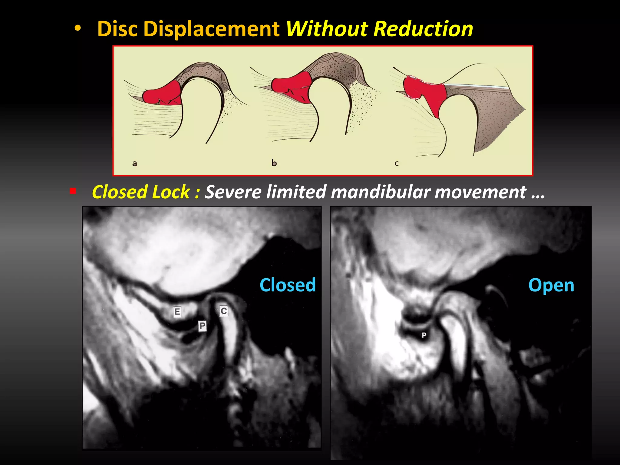 TMD's and occlusal splint therapy | PDF | Bone and Joint Conditions ...