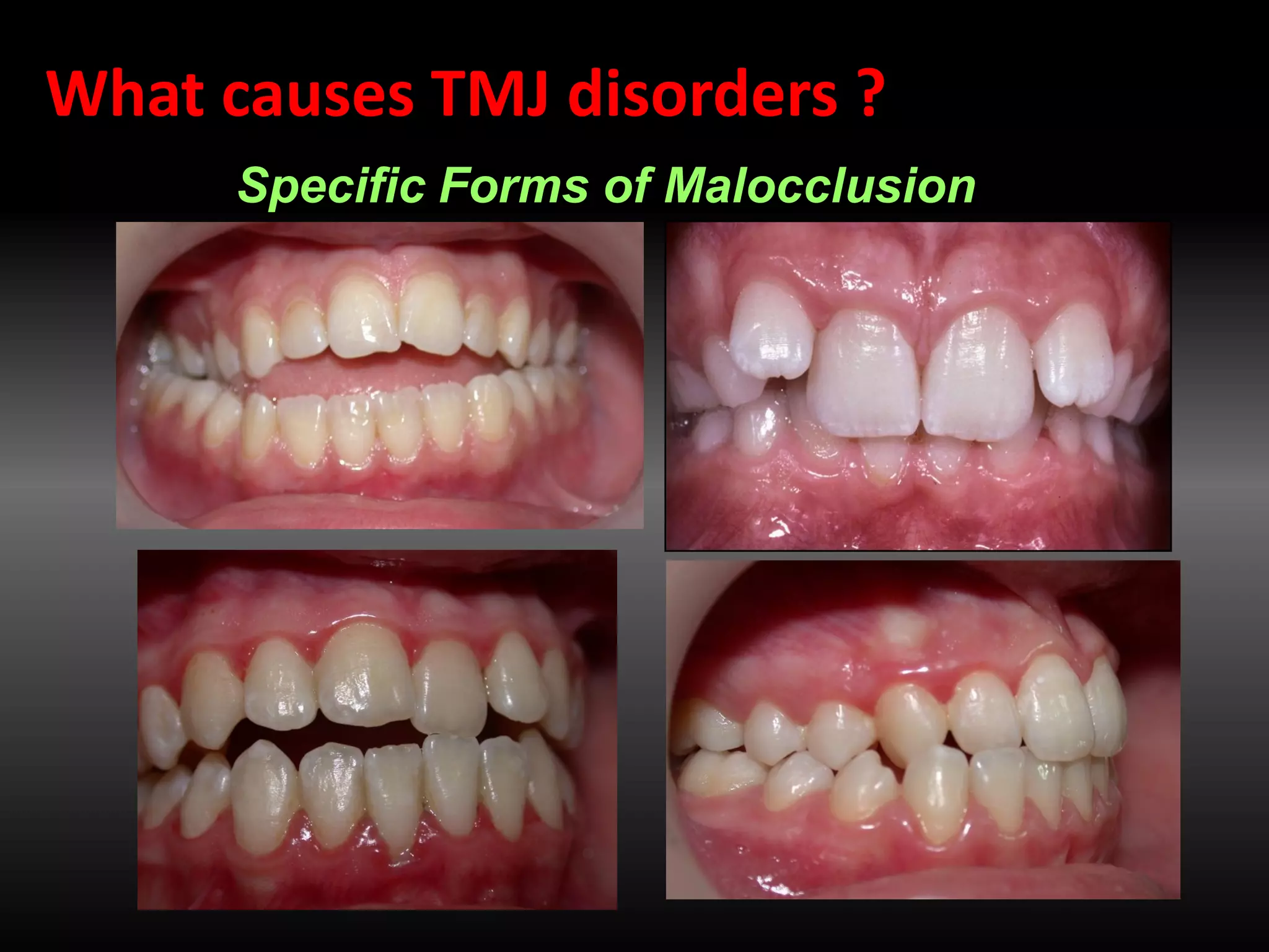 TMD's and occlusal splint therapy | PDF