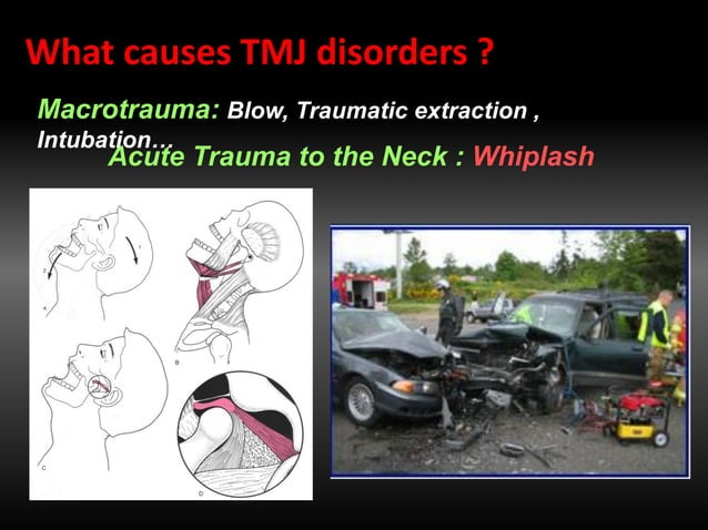TMD's and occlusal splint therapy | PDF | Bone and Joint Conditions ...
