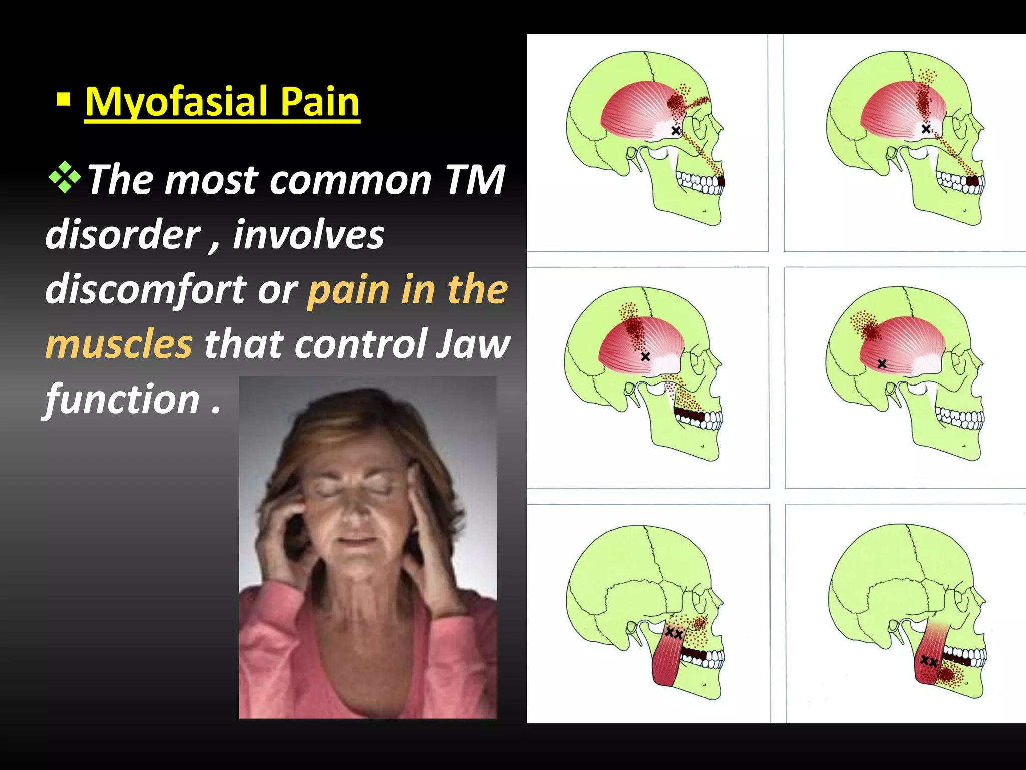 TMDs and occlusal splints therapy | PDF