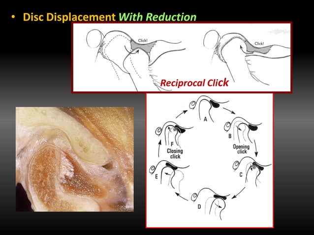 TMDs and occlusal splints therapy | PDF