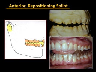 TMDs and occlusal splints therapy | PDF