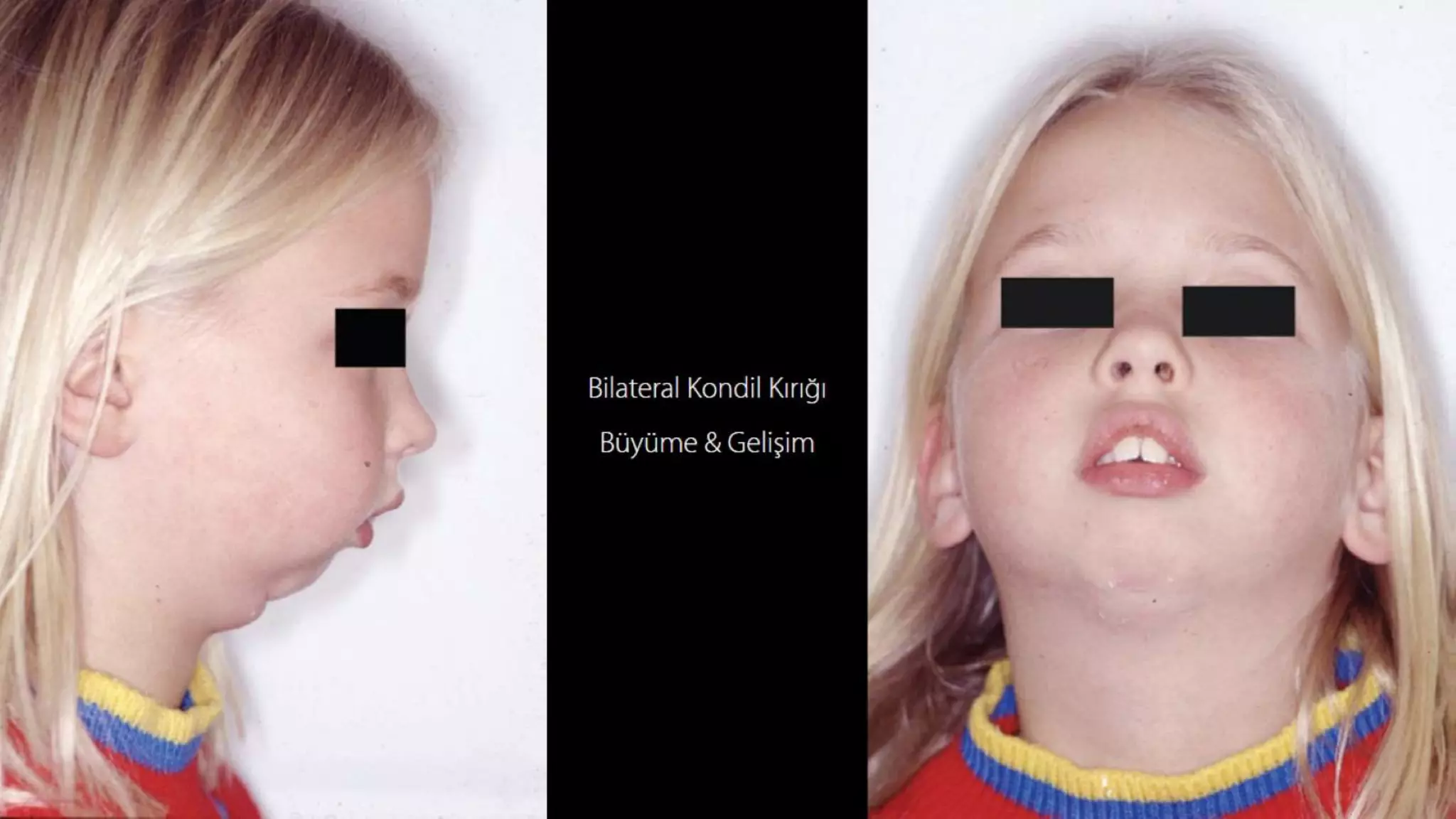 Tempromandibular Eklemde Hipomobilite | PPT