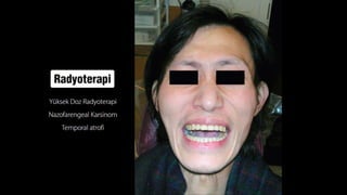 Tempromandibular Eklemde Hipomobilite | PPT