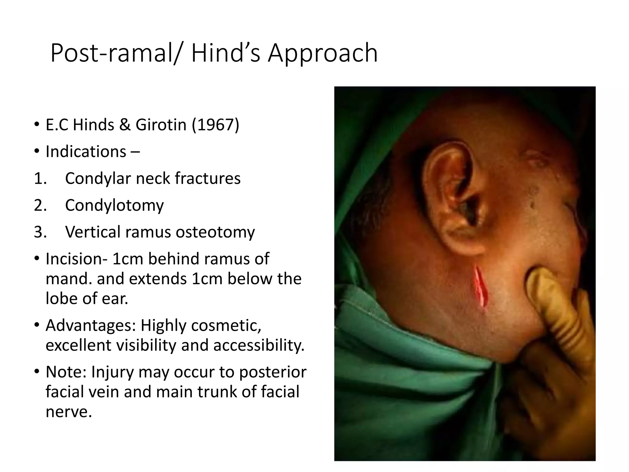 Surgical Anatomy of Temporomandibular Joint | PPTX