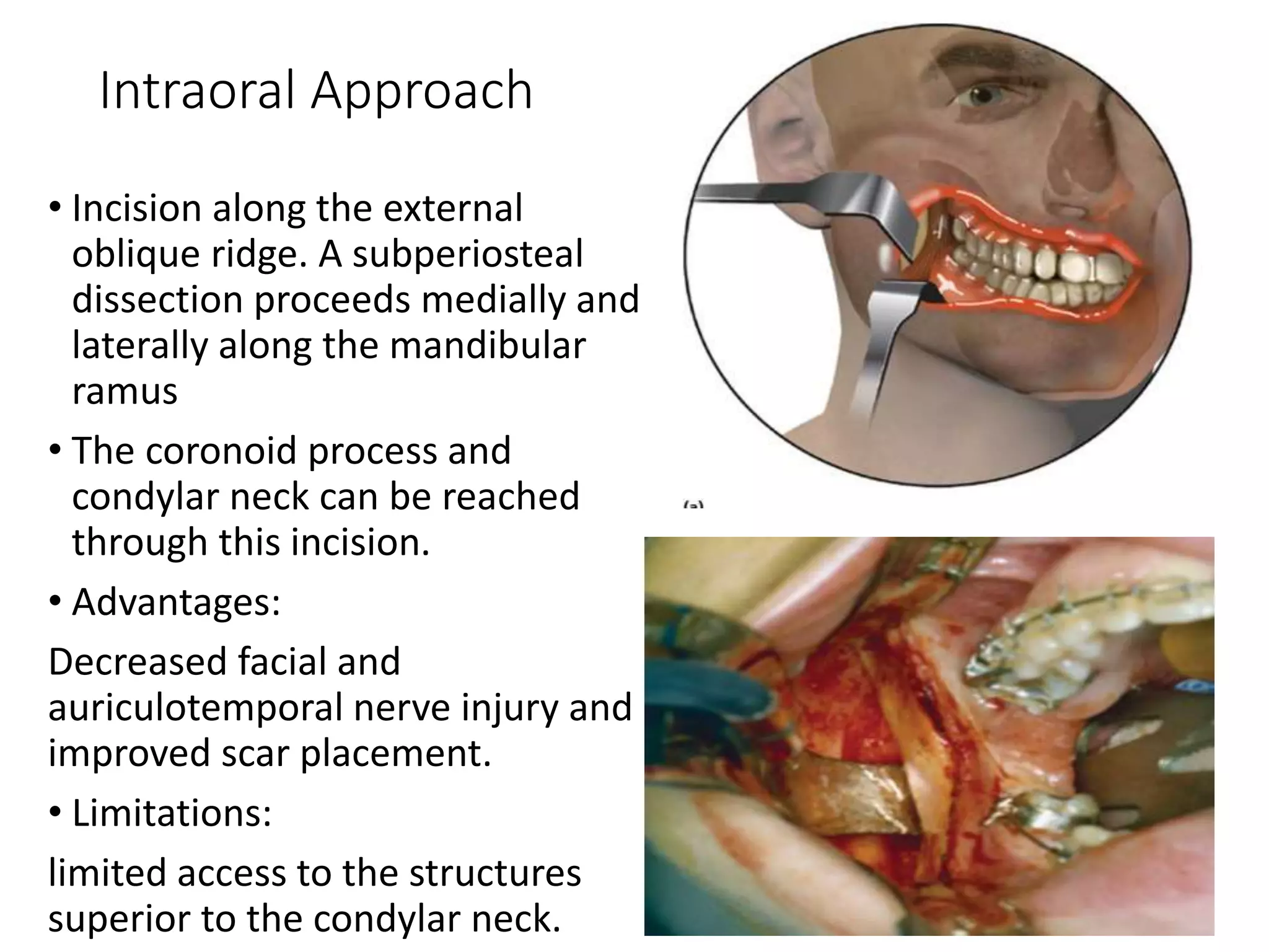 Surgical Anatomy of Temporomandibular Joint | PPTX