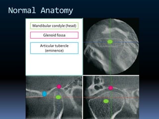 TMJ details and easy to understand it.ppt