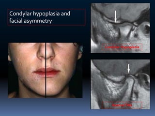TMJ details and easy to understand it.ppt