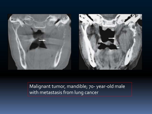 TMJ details and easy to understand it.ppt