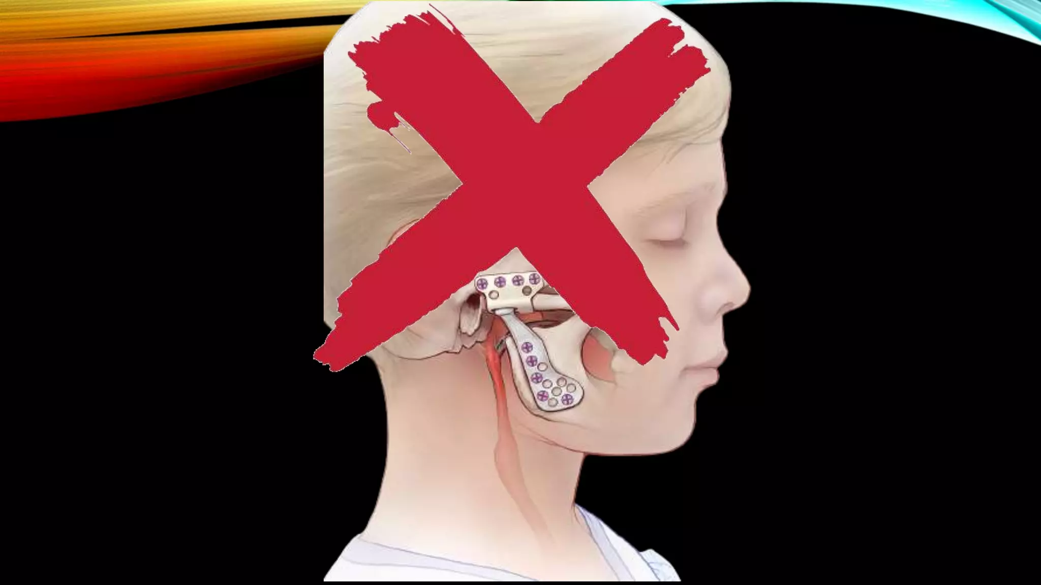 TMJ RECONSTRUCTION | PPTX