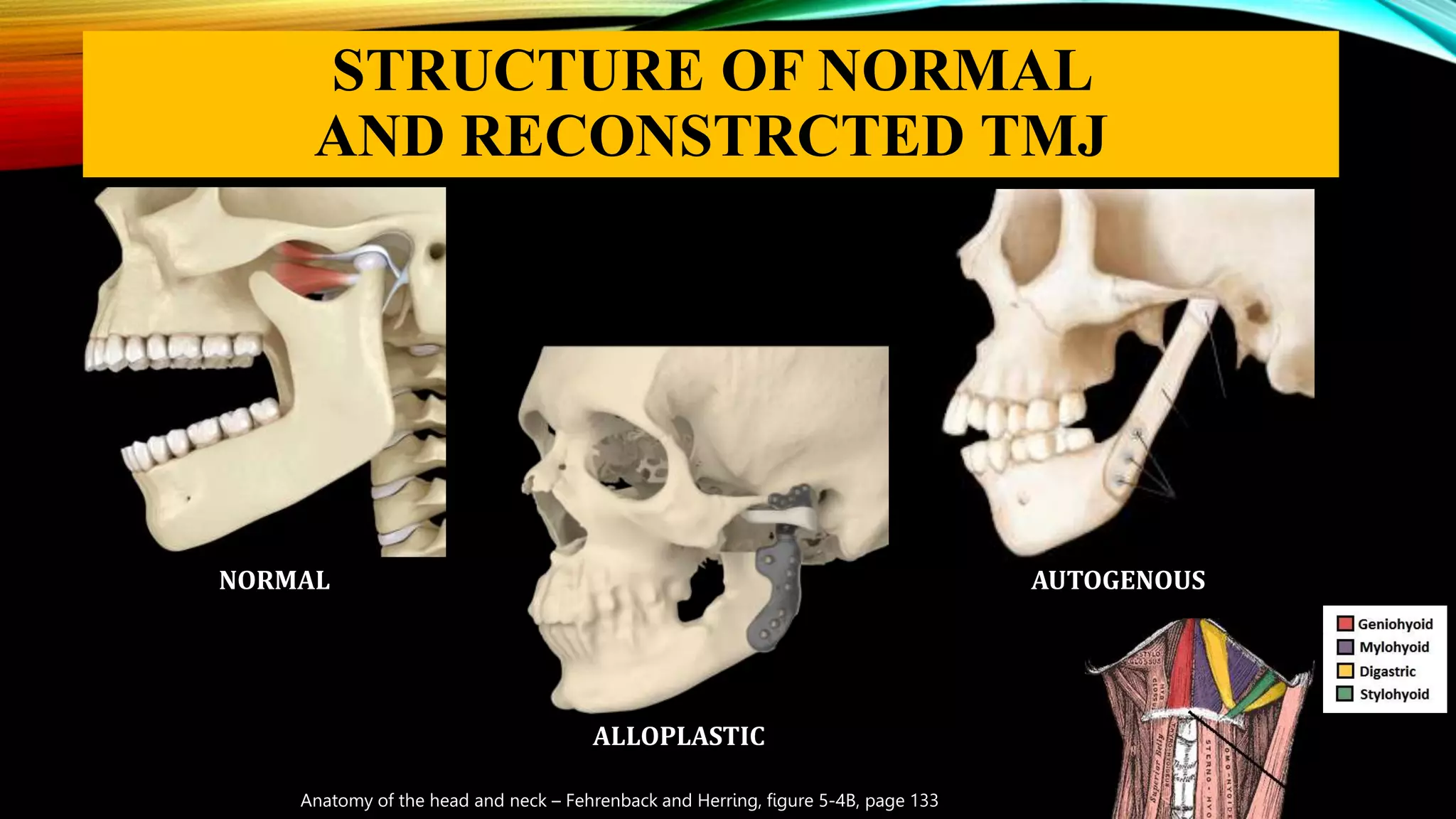 TMJ RECONSTRUCTION | PPTX