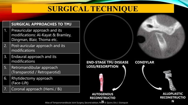 TMJ RECONSTRUCTION | PPTX