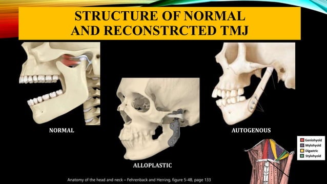 TMJ RECONSTRUCTION | PPTX