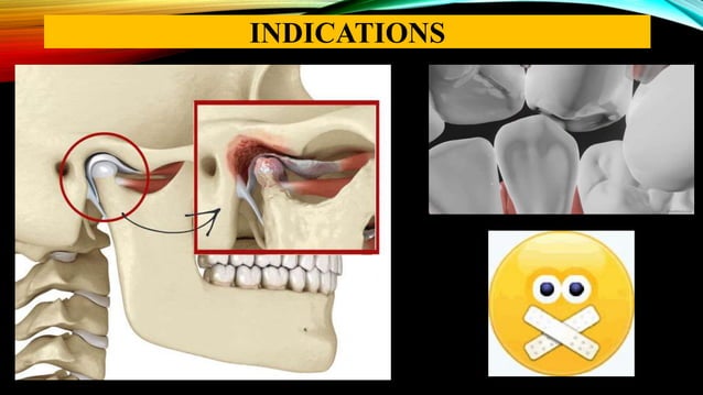 TMJ RECONSTRUCTION | PPTX
