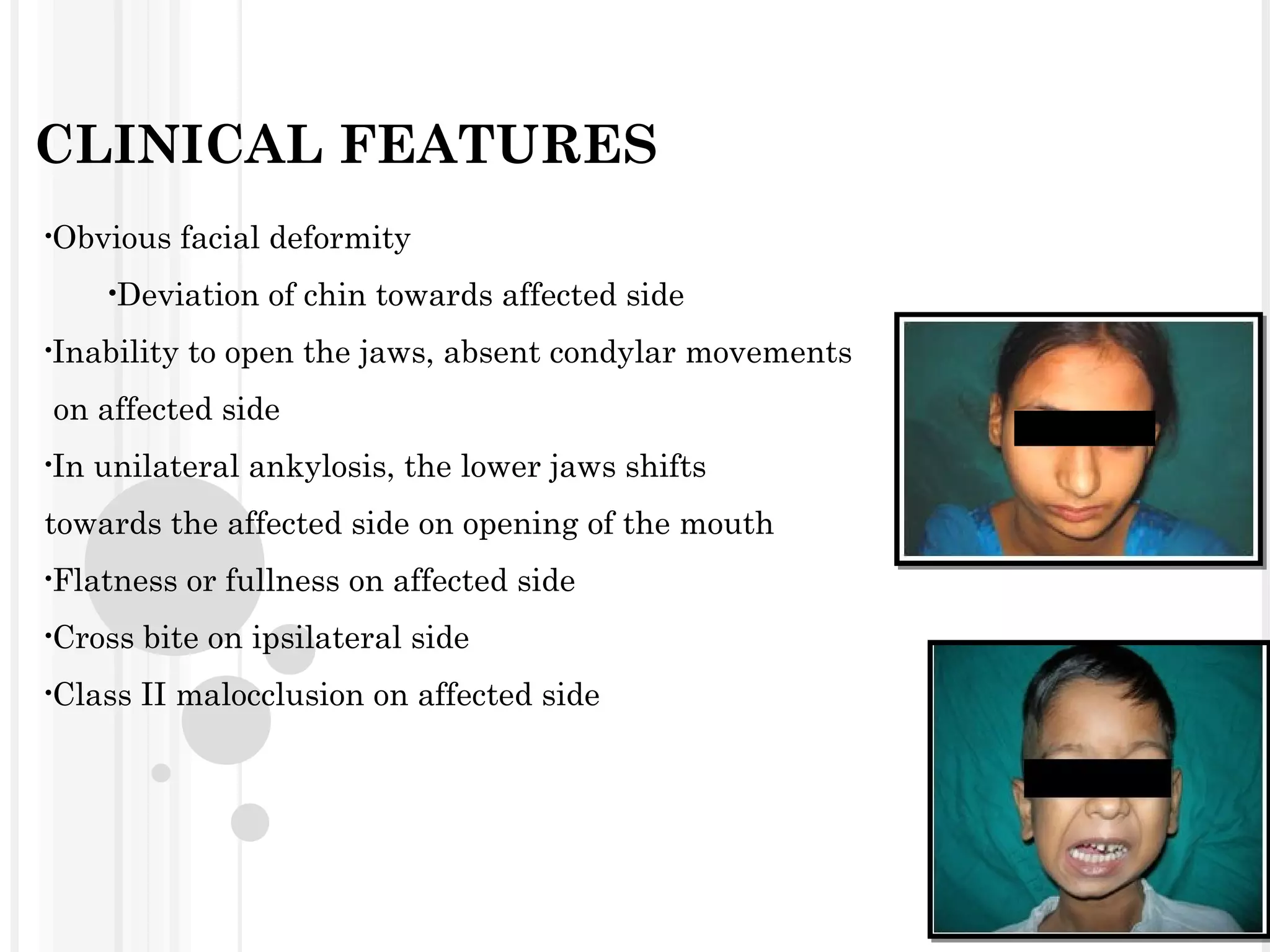 Tmj ankylosis | PPT