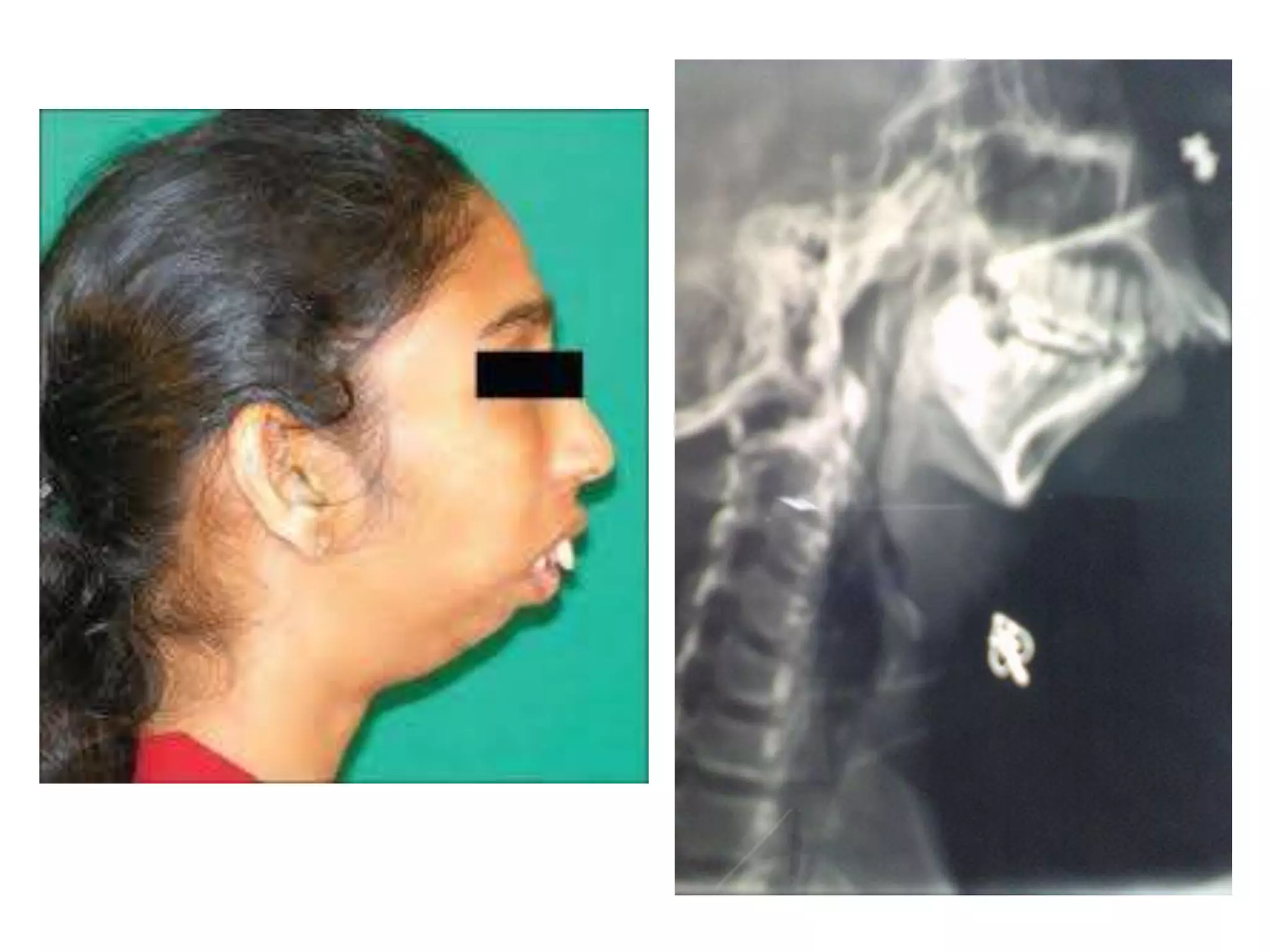 Tmj ankylosis | PPTX