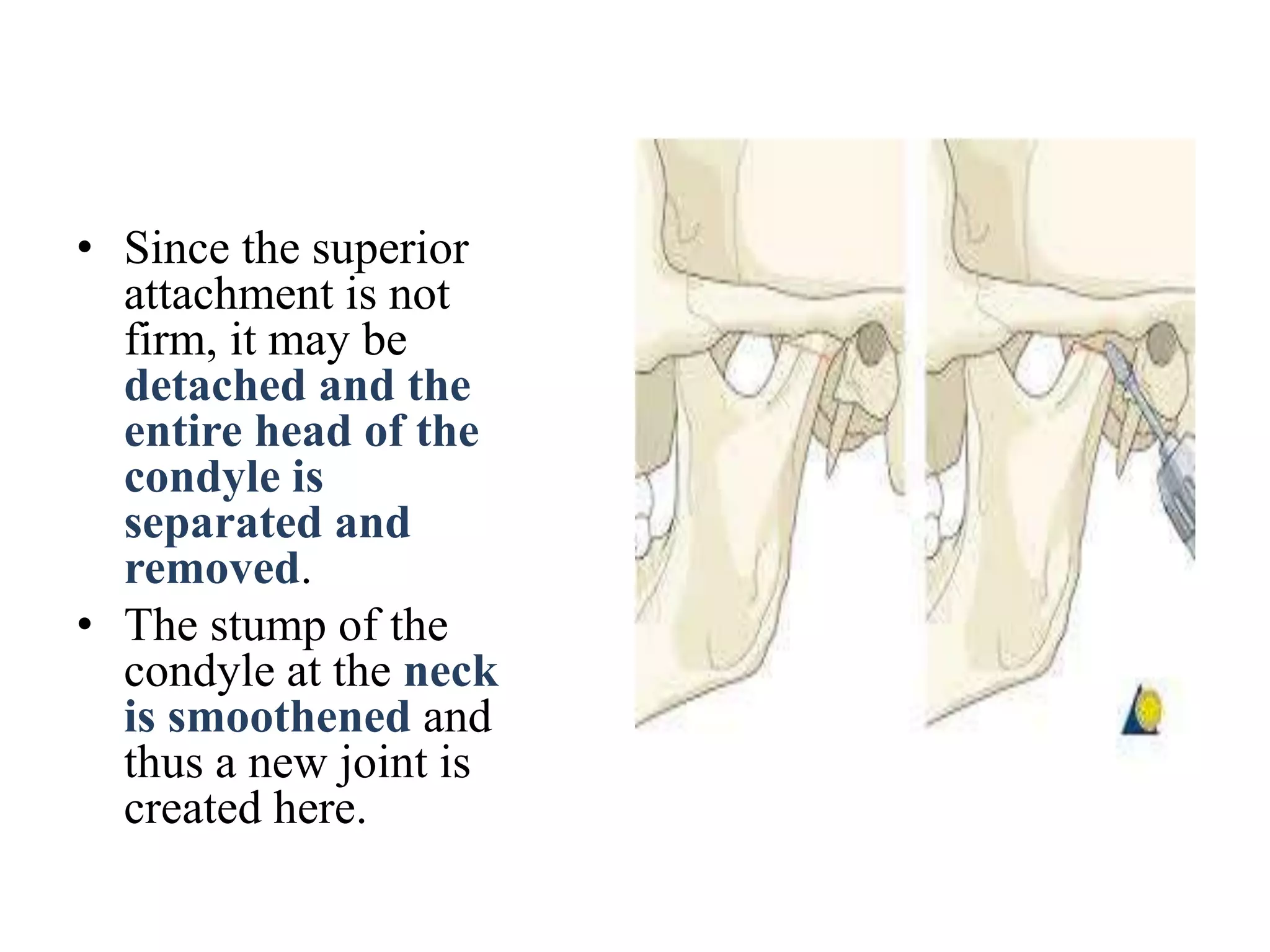 Tmj ankylosis | PPTX
