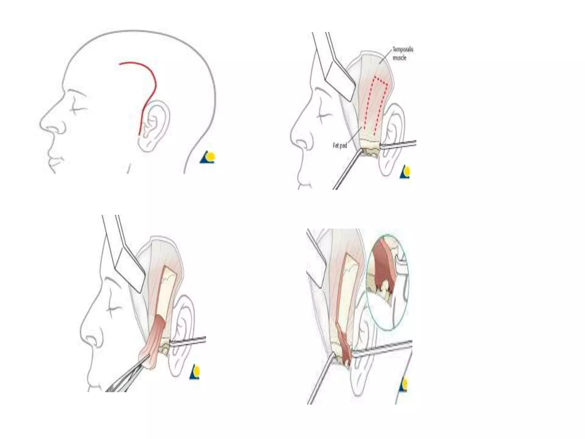 Tmj ankylosis | PPTX