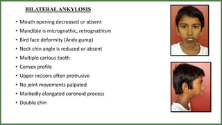 Tmj ankylosis | PPTX