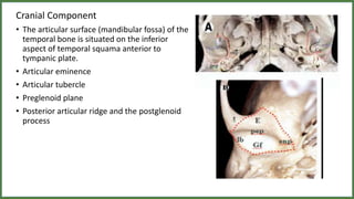 Tmj ankylosis | PPTX