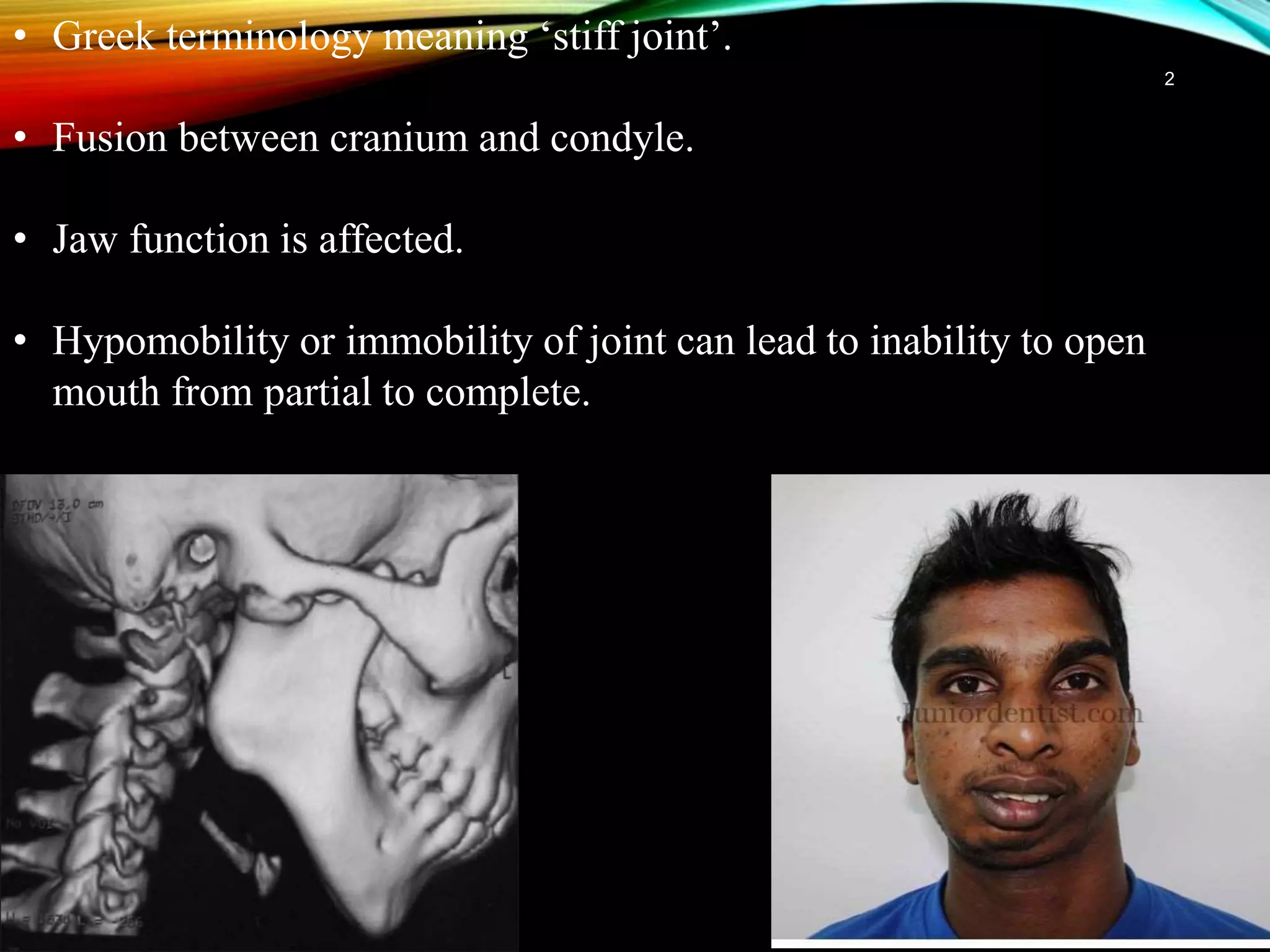 Tmj ankylosis-oral and maxillofacial surgery | PPTX