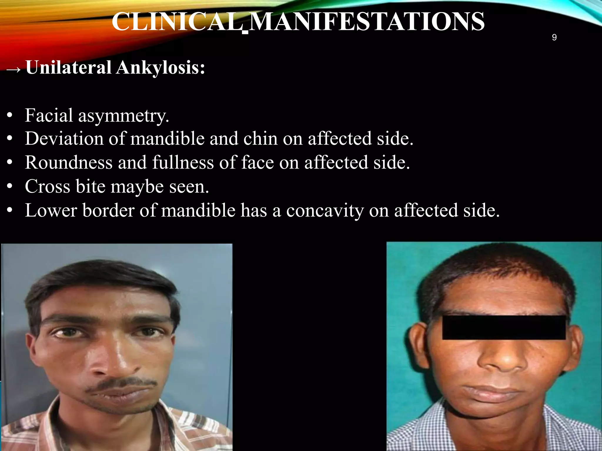 Tmj ankylosis-oral and maxillofacial surgery | PPTX