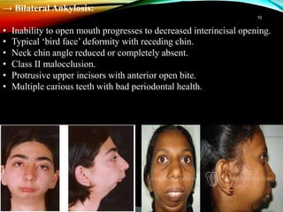 Tmj ankylosis-oral and maxillofacial surgery | PPTX