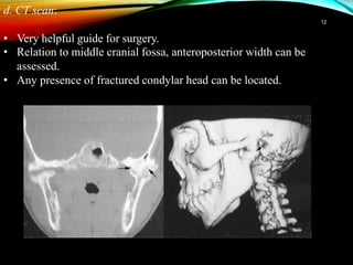 Tmj ankylosis-oral and maxillofacial surgery | PPTX
