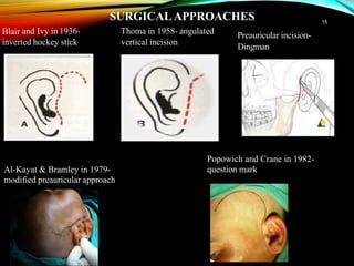 Tmj ankylosis-oral and maxillofacial surgery | PPTX