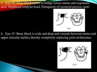 Tmj ankylosis-oral and maxillofacial surgery | PPTX