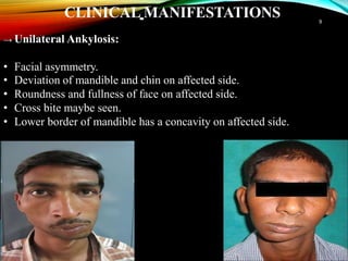 Tmj ankylosis-oral and maxillofacial surgery | PPTX