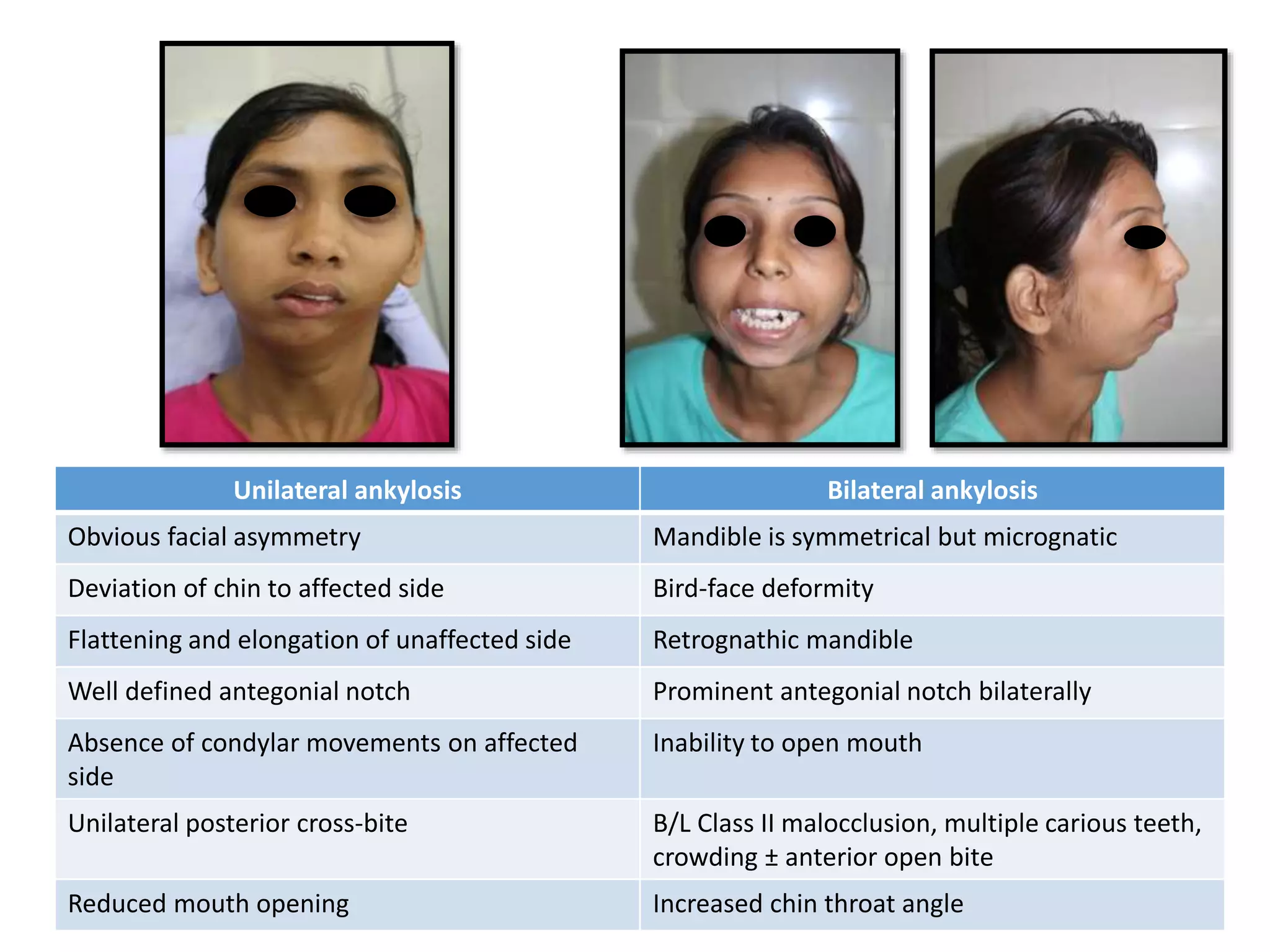 Temporomandibular joint ankylosis and its management | PPTX