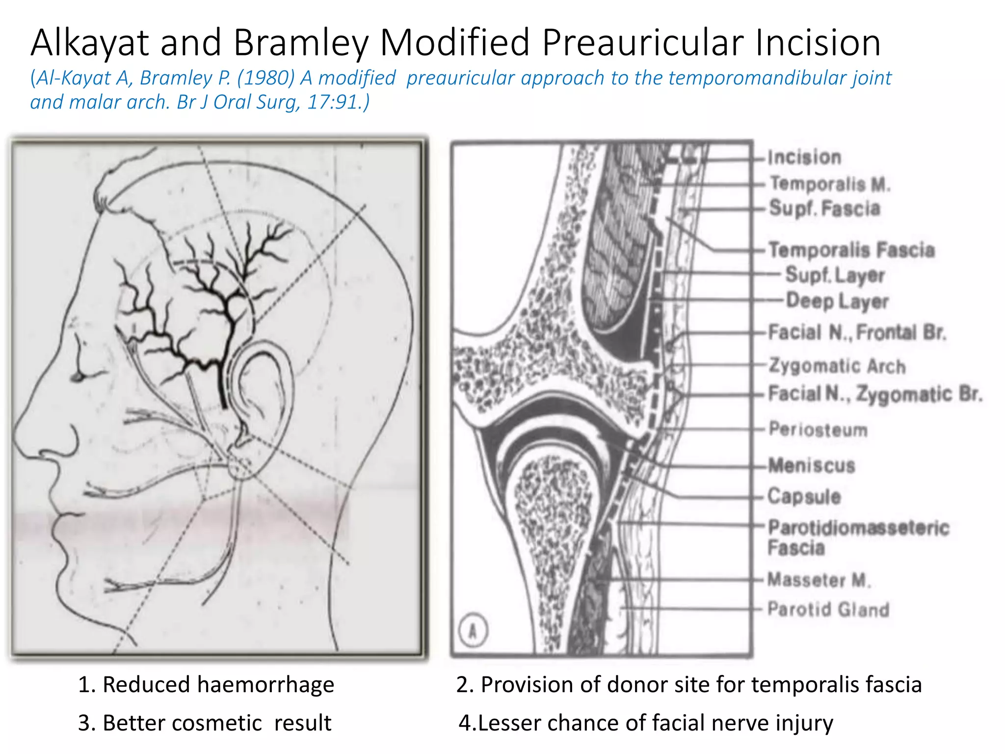 Temporomandibular joint ankylosis and its management | PPTX