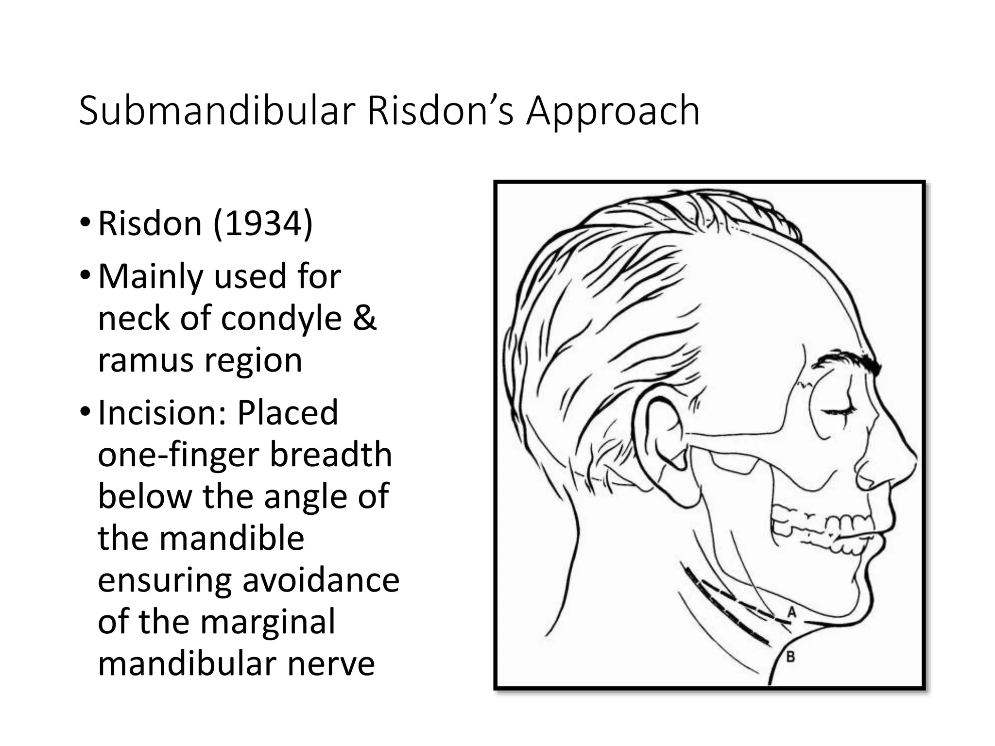 Temporomandibular joint ankylosis and its management | PPTX