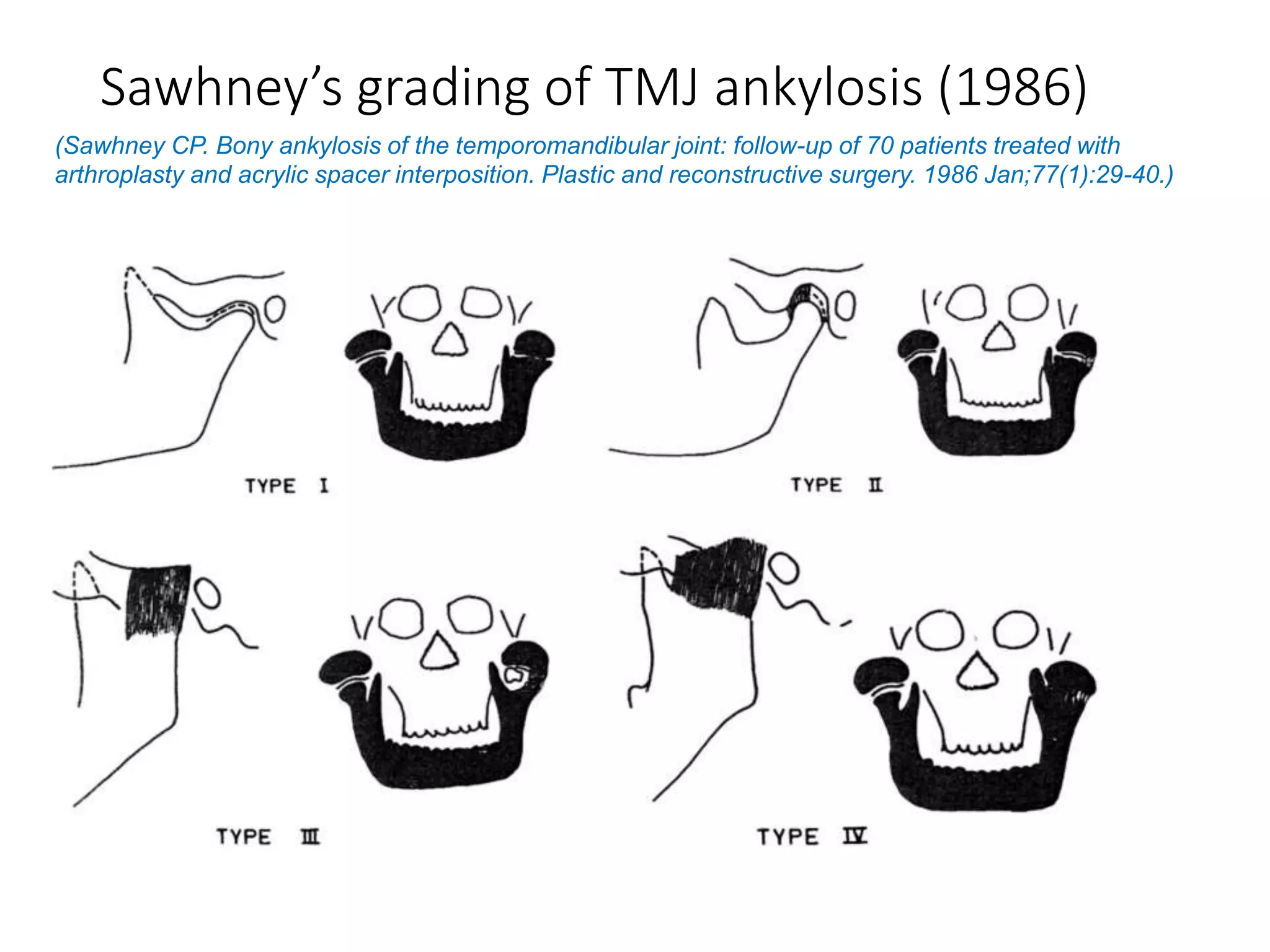 Temporomandibular joint ankylosis and its management | PPTX