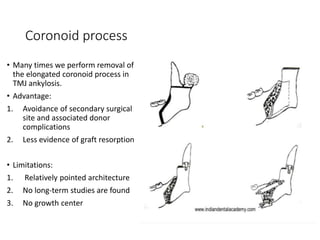 Temporomandibular joint ankylosis and its management | PPTX