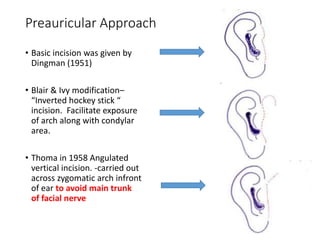 Temporomandibular joint ankylosis and its management | PPT