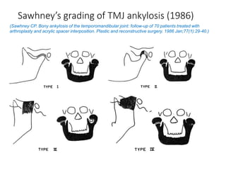 Temporomandibular joint ankylosis and its management