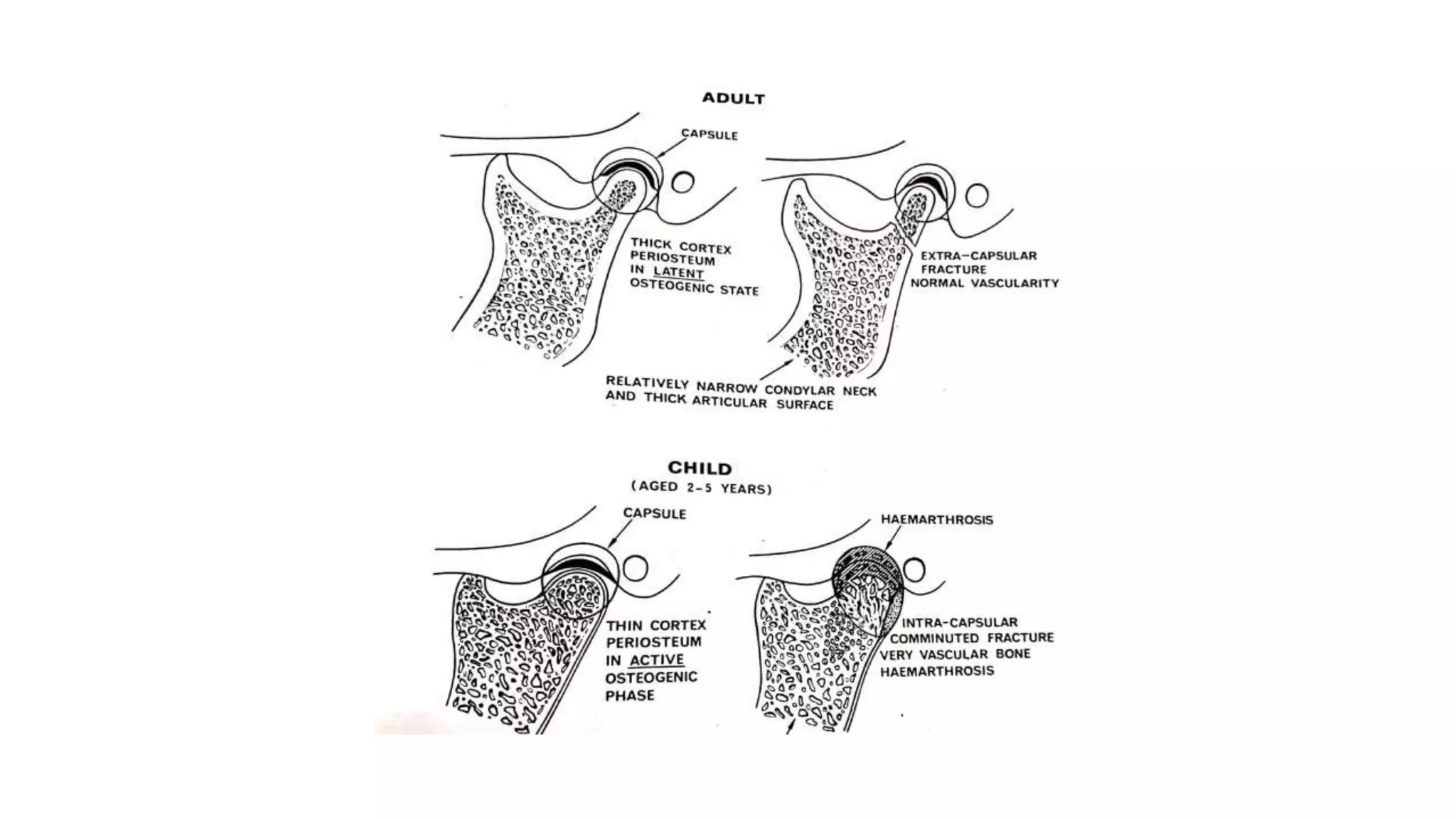 TMJ Ankylosis & It's Management | PPTX