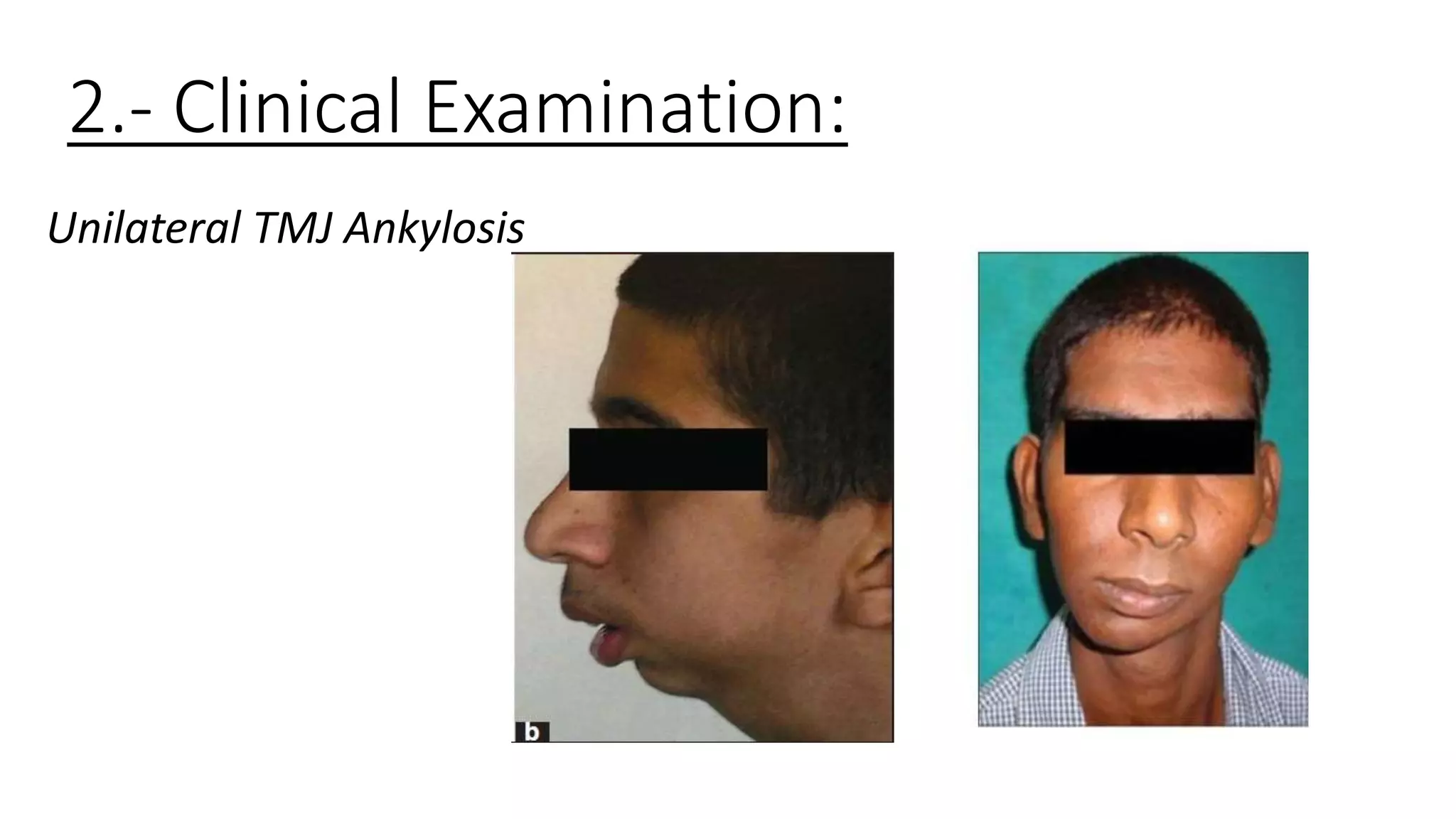 TMJ Ankylosis & It's Management | PPTX