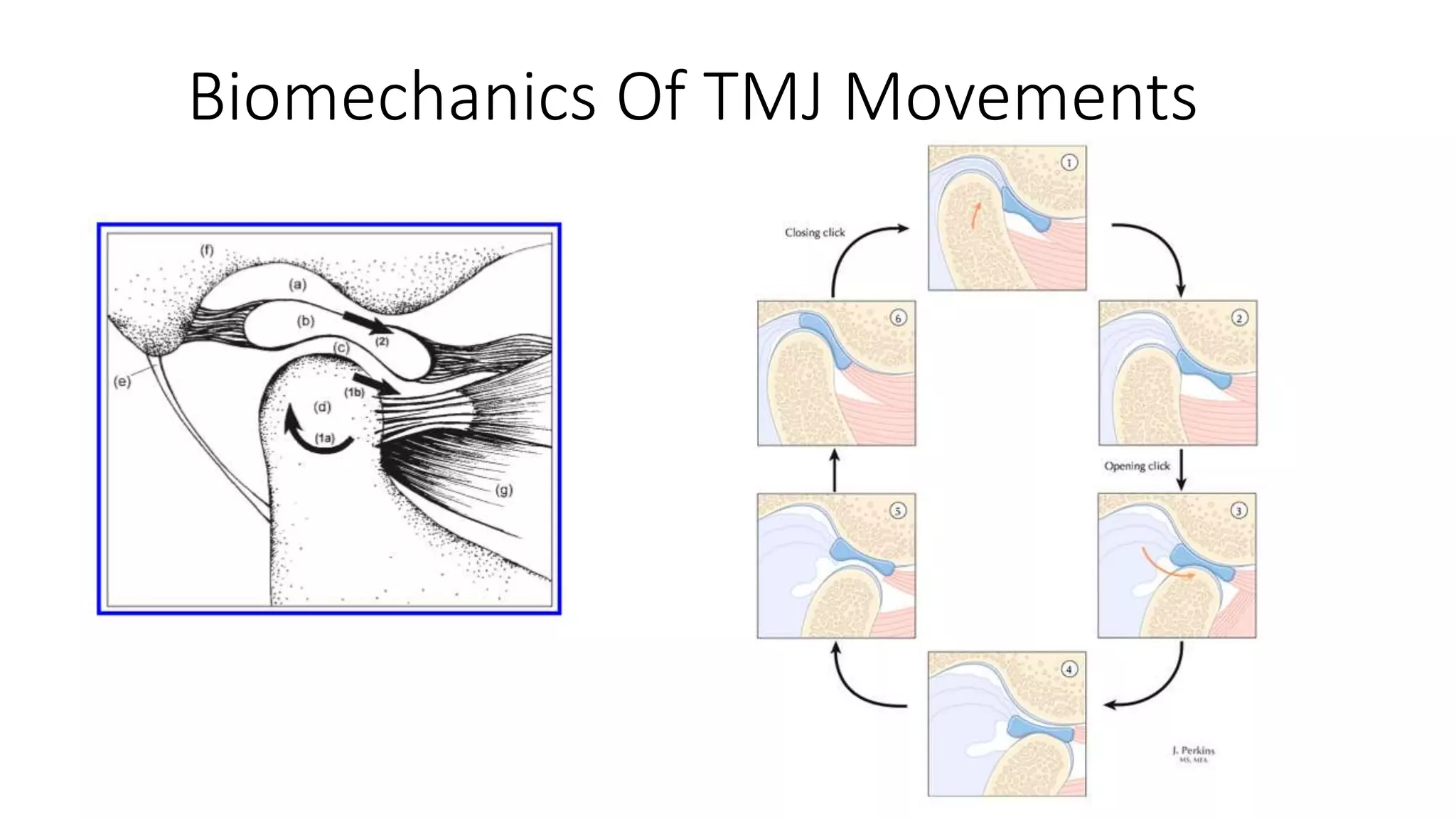 TMJ Ankylosis & It's Management | PPTX